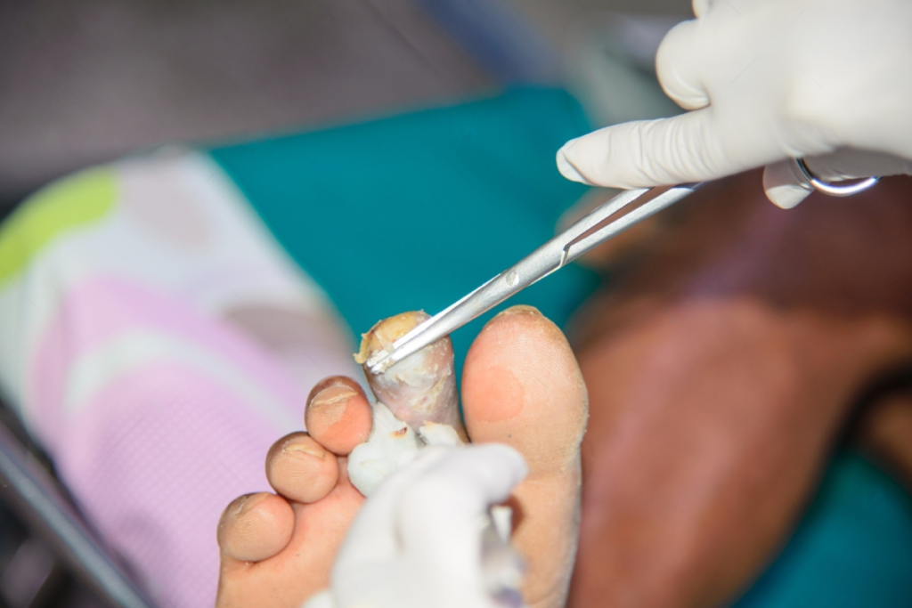 The Role of Infection Control in Diabetic Foot Ulcers Treatment ...
